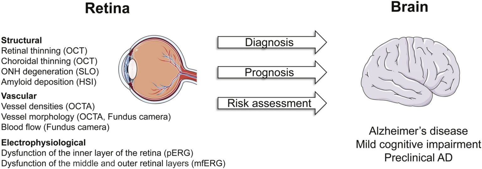A Breakthrough in Retinal Research Helps Diagnose Alzheimer's - Cielito ...